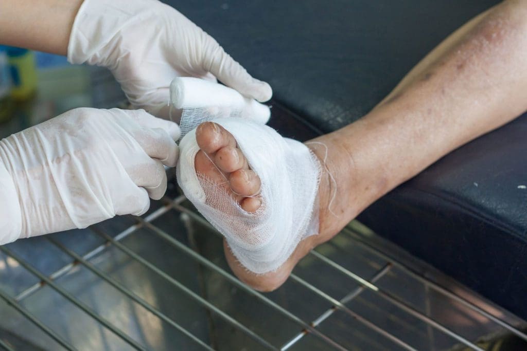 Diabetic Foot Amputation