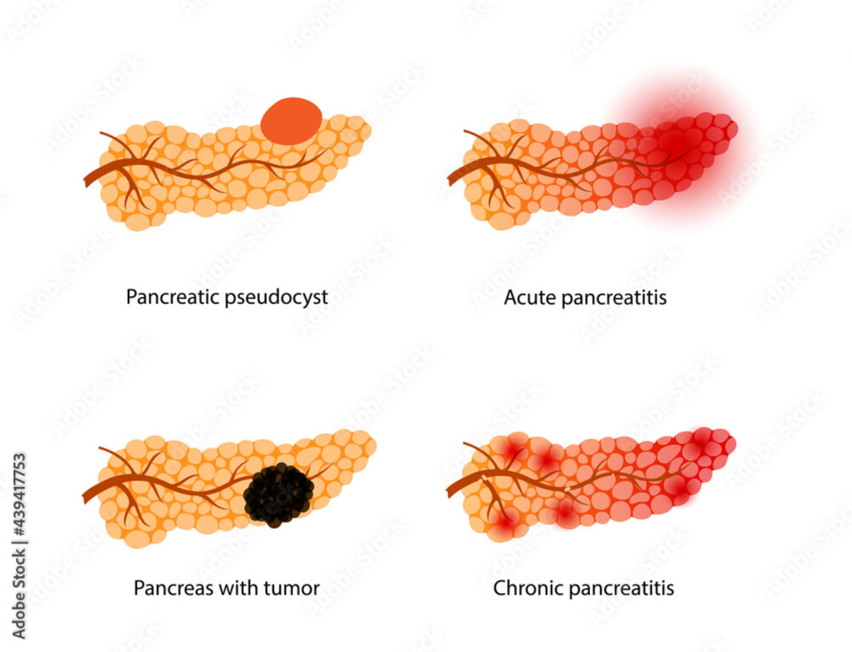 Pancreatic Cyst Surveillance - Southern California Multi-Specialty Center